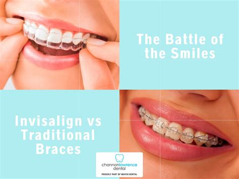 5 Clear Benefits Of Clear Braces