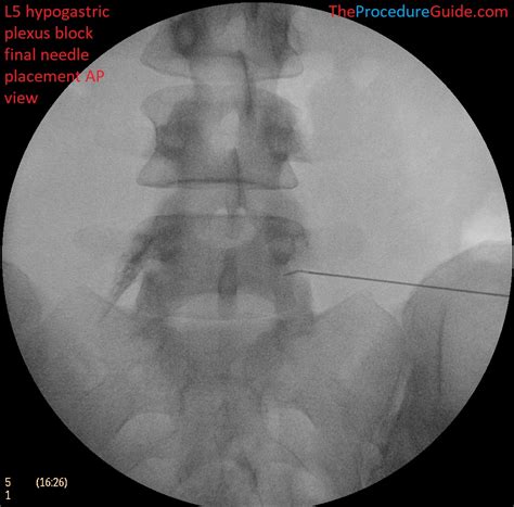 Fluoroscopic Guided Sacral Transforaminal Epidural Steroid Injection