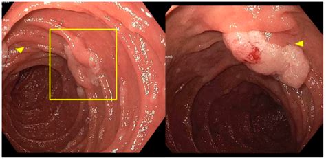 Endoscopic Management Of Ampullary Adenomas A Comprehensive Review
