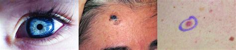 Types Of Melanoma The Characteristics The Differences And What You Need To Know MoleMap