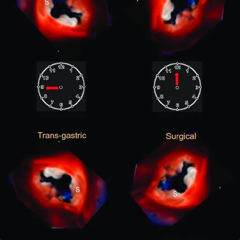 The Four Classic En Face Views Of Tricuspid Valve S Septal Leaflet