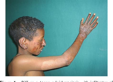 Diffuse Cutaneous Leishmaniasis