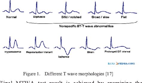 Figure 1 From A New Method To Compute T Wave Alternans Semantic Scholar