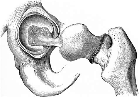 Hip Ball And Socket Joint Dislocation At Thomas Reiser Blog