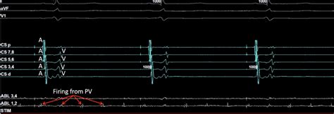 Electrogram Interpretation 7 Ep Essentials