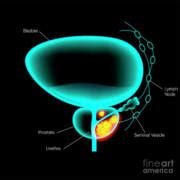 Prostate Cancer 13 Photograph By Pikovit Science Photo Library