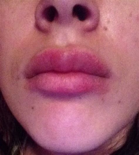 Irritant Contact Dermatitis Lips