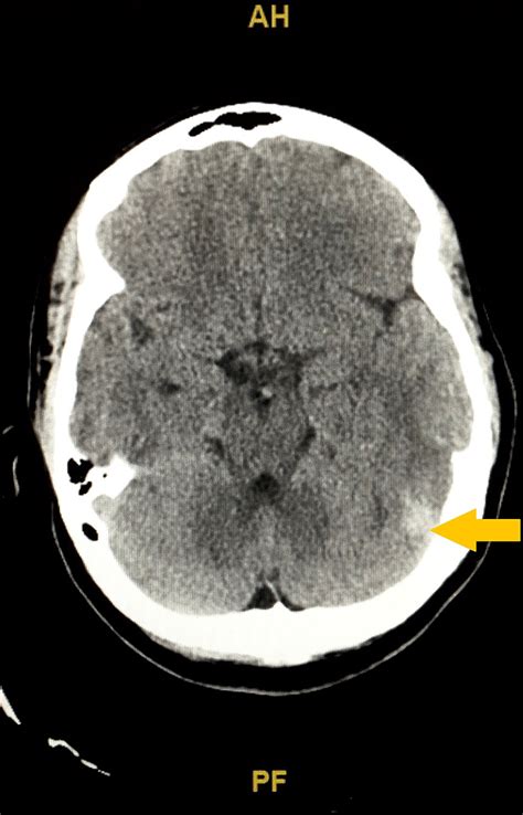 Ct Of Head Without Contrast Showing Hyperdensity Along The Tentorium On Download Scientific