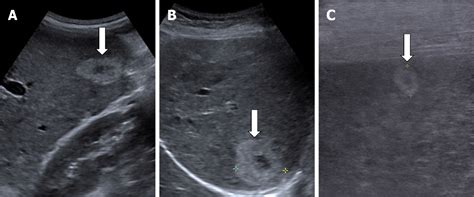 Cavernous Hemangioma Liver Ultrasound