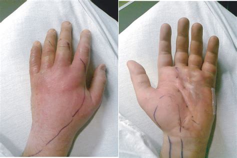 Necrotizing Fasciitis Hand