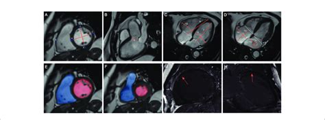 Protocol For Cmr Contouring Of The Ventricles Atria And Artery Roots Download Scientific