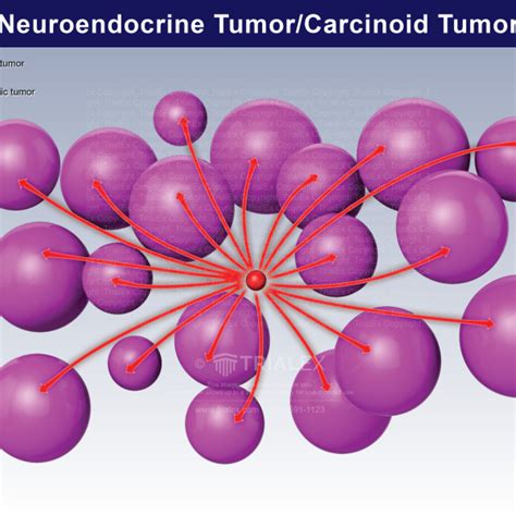 Medical Legal Exhibits Legal Animations And Trial Graphics Tria