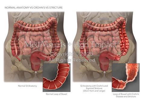 Normal Anatomy Vs Crohns Vs Stricture Medivisuals High Impact