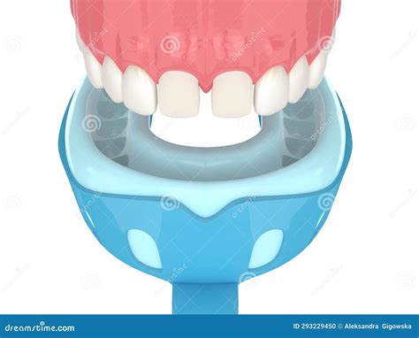 Mandibular Arch With Buccal Nerve Block Royalty Free Stock Image