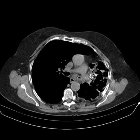 Radiopaedia Case Cystic Bronchiectasis Id 35306 Study 36813 Nc Commons