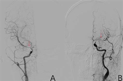 A Is A 45 Year Old Female This Is A Dsa Image Of His Right Common