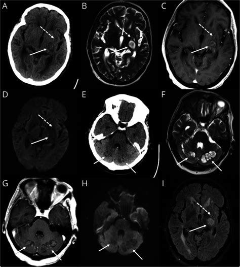 Teaching Neuroimage Cryptococcal Meningoencephalitis With Cryptococcoma And Gelatinous