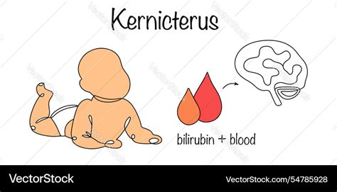 Kernicterus Royalty Free Vector Image Vectorstock