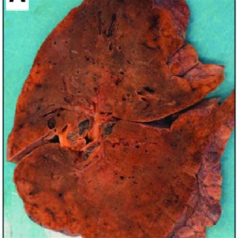 Macroscopic Picture Of A Lung Taken During A Post Mortem Autopsy Of A