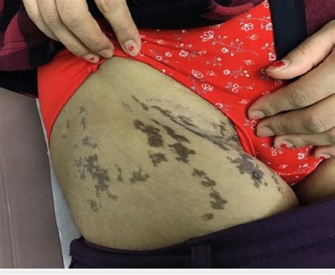 Multiple Well Demarcated Hyperpigmented Macules And Patches On The