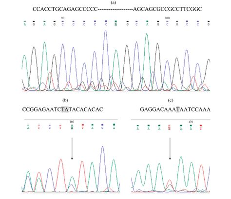 Sanger Sequencing Results A Cebpa Deletion With Frameshift 11