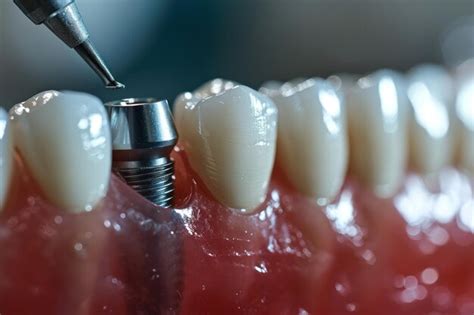 Closeup Dental Implant Installation Process Premium Ai Generated Image
