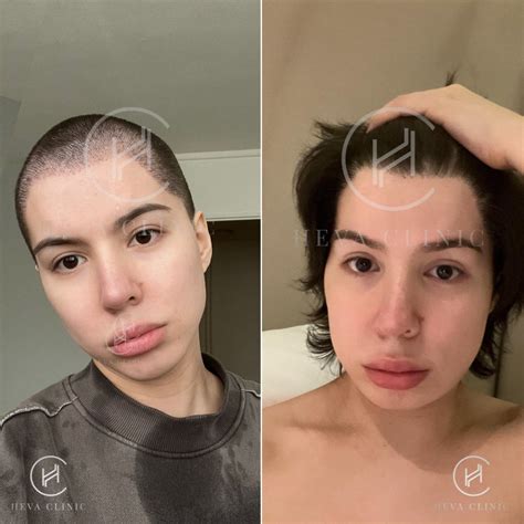 Mtf Transgender Hair Transplant Process And Costs In 2025