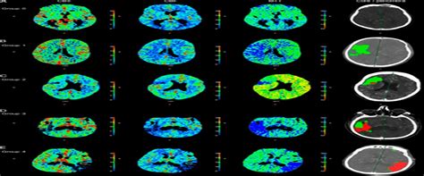A Novel Fast Ct Perfusion Core Penumbra Mismatch Score Corr The Neurologist