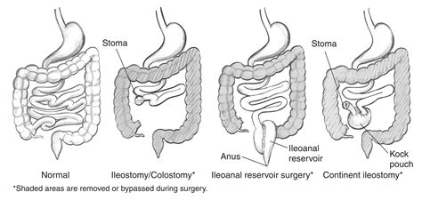 Normal Bowel And Three Types Of Bowel Diversion Surgeries Including Ileostomy Colostomy