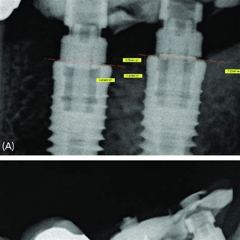 Marginal Bone Defects As Measured In The Present Study Based On