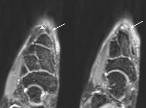 A Complete Rupture Of The Extensor Hallucis Longus Tendon With