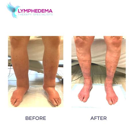 Lymphedema Compression Lymphaticdrainage Mld Linfedema Lymphoedema Lymphedema Therapy