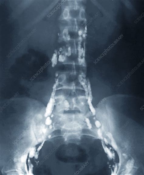 Normal Lymphatic System X Ray Stock Image C0269941 Science