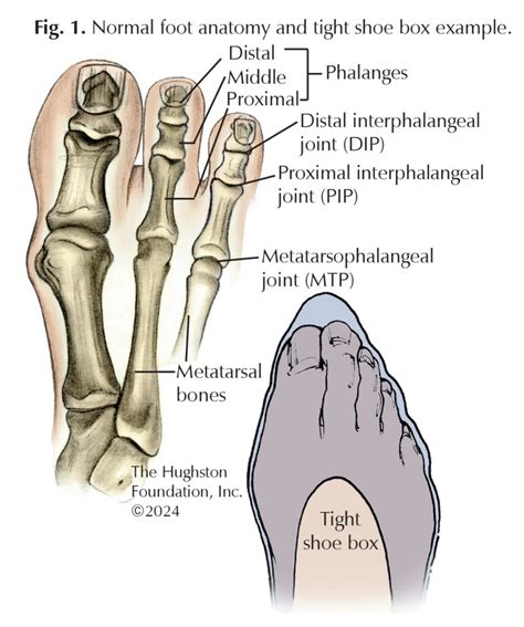 Interphalangeal Joint Toe Toe Joint Deformities