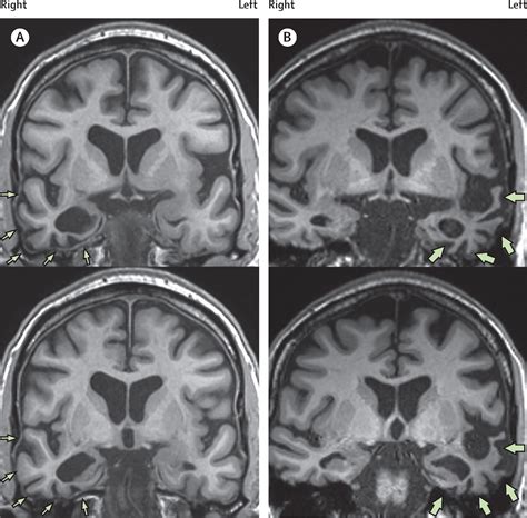Advances And Controversies In Frontotemporal Dementia Diagnosis