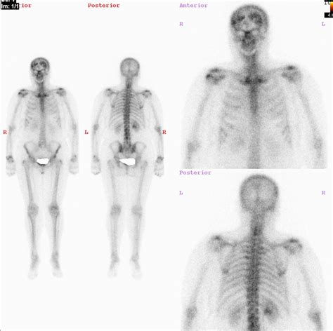 99mtc Methylene Diphosphonate Planar Bone Scan Reveal Asymmetrical