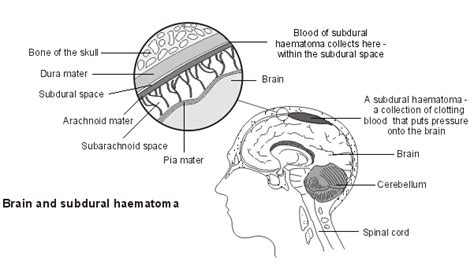 Subdural Hematoma Infant
