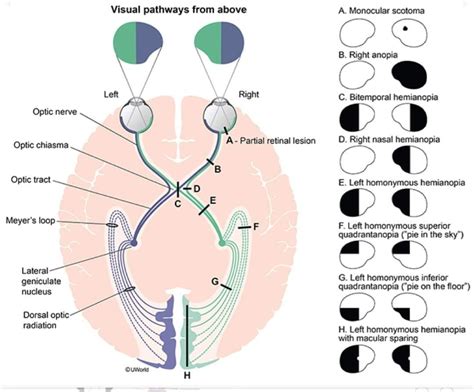 Quadrantanopia Visual Field Defect Medbullets On X Contralateral