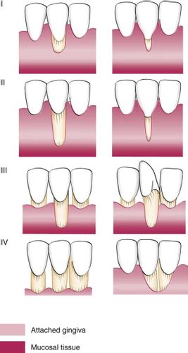Mucogingival Deformities Flashcards Quizlet