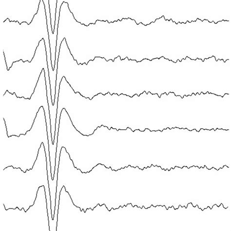 Saphenous Nerve Somatosensory Evoked Potential Elicited Sap Sep By Download Scientific