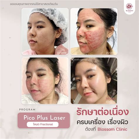 Pico Laser คืออะไร ทำไมถึงยอดนิยม ลดกระ ฝ้า ที่ Blossomclinic