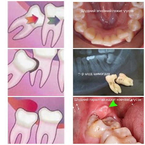 Та энэ талаар Дэлбээ дент шүдний гажиг заслын эмнэлэг