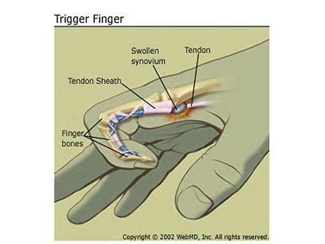 How to treat trigger finger without surgery – Artofit