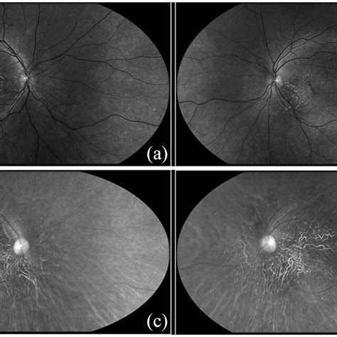 The Optos Imaging Using Green Reflectance A B Showed Central Macular