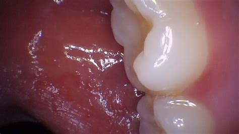 Perfectcam Intraoral Camera Ioc Snapshot