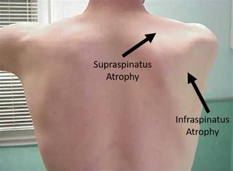 Suprascapular Neuropathy Emg Solutions