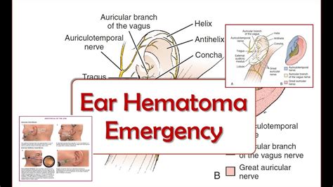 Auricular Hematoma In Dogs