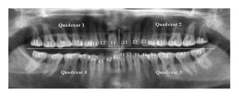 Fdi Nomenclature Illustrated On A Panoramic Radiograph Download Scientific Diagram