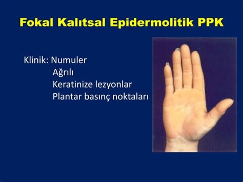 Palmoplantar Keratoderma Ppt