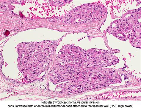 Pathology Outlines Follicular Thyroid Carcinoma